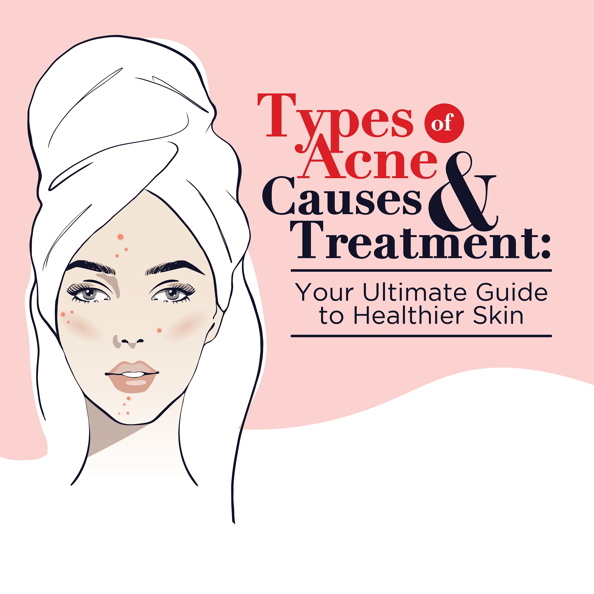 Types of Acne, Causes, and Treatment (Infographic) | Tips for Natural ...